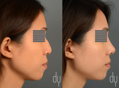 Finesse Asian Rhinoplasty with DCF (Diced Cartilage Fascia) - Beverly ...