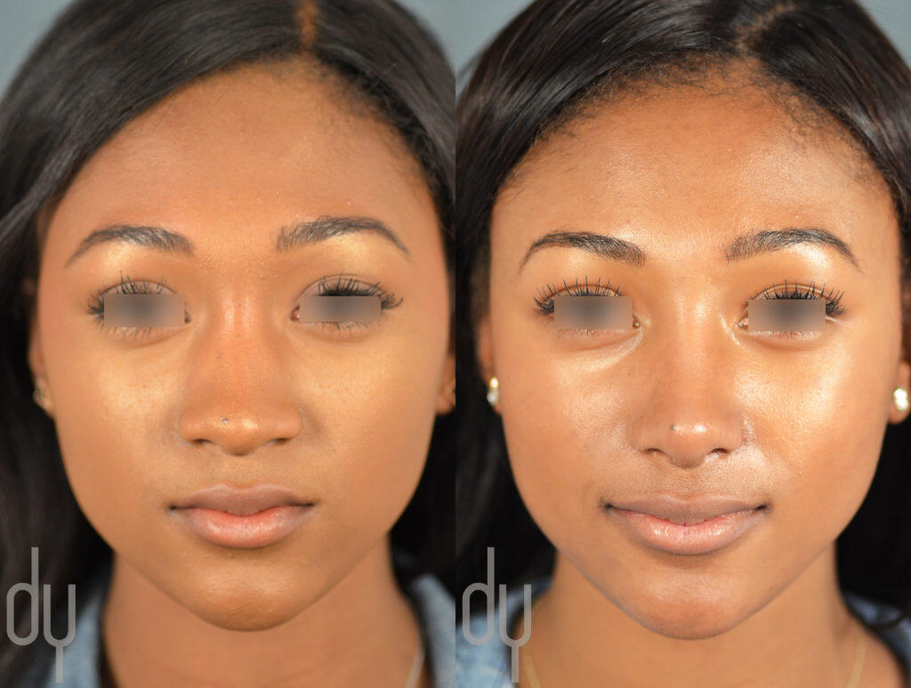 Primary Rhinoplasty|Before and After - Beverly Hills Facial Plastic ...