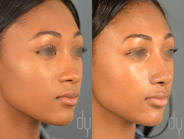 Primary Rhinoplasty|Before and After - Beverly Hills Facial Plastic ...