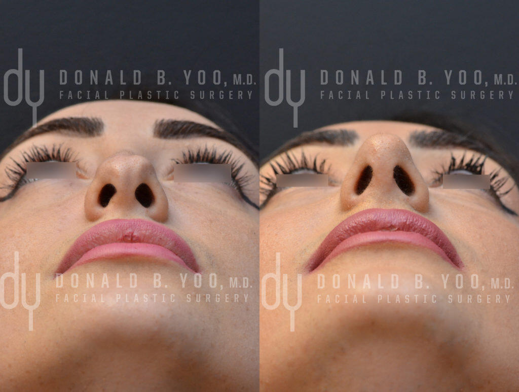 Open Revision Rhinoplasty | Before and After | Beverly Hills Facial ...