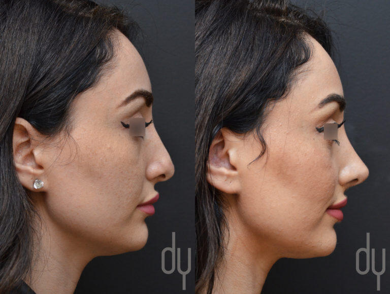 Open Revision Rhinoplasty | Before and After - Beverly Hills Facial ...