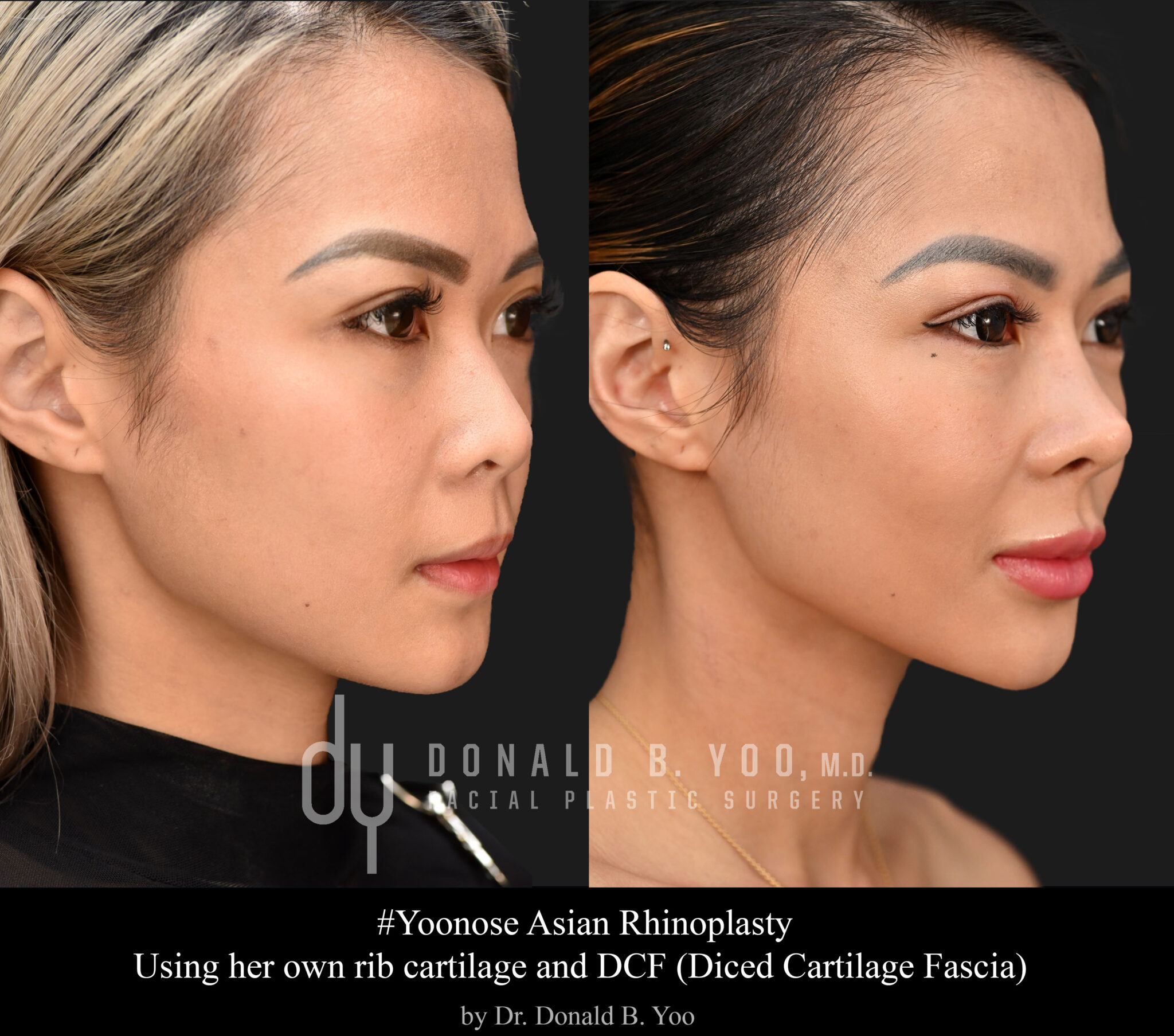 Considerations during Asian Rhinoplasty and Asian Nose Job using your ...