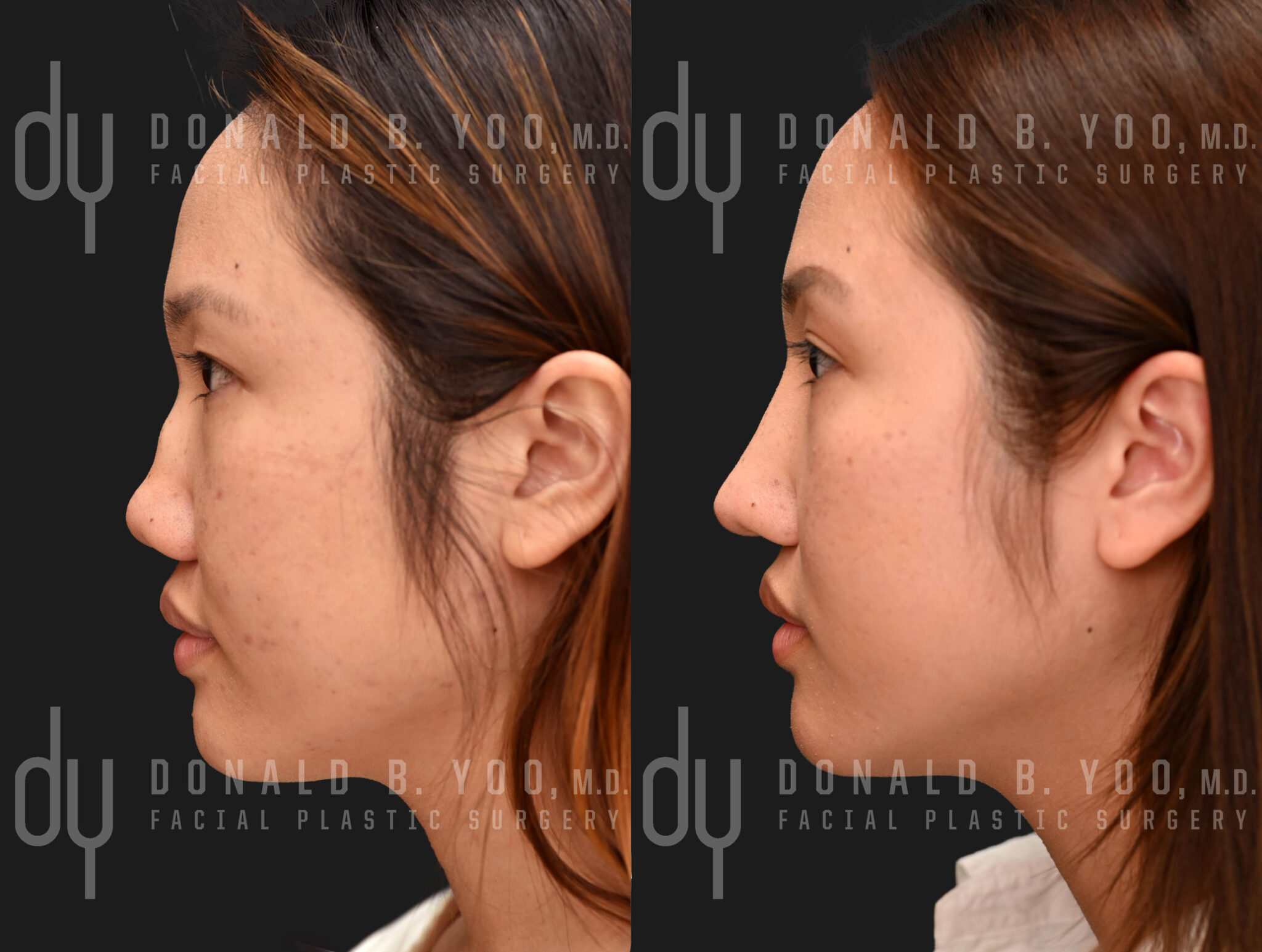 What is a spreader graft in Rhinoplasty? What purpose do spreader ...