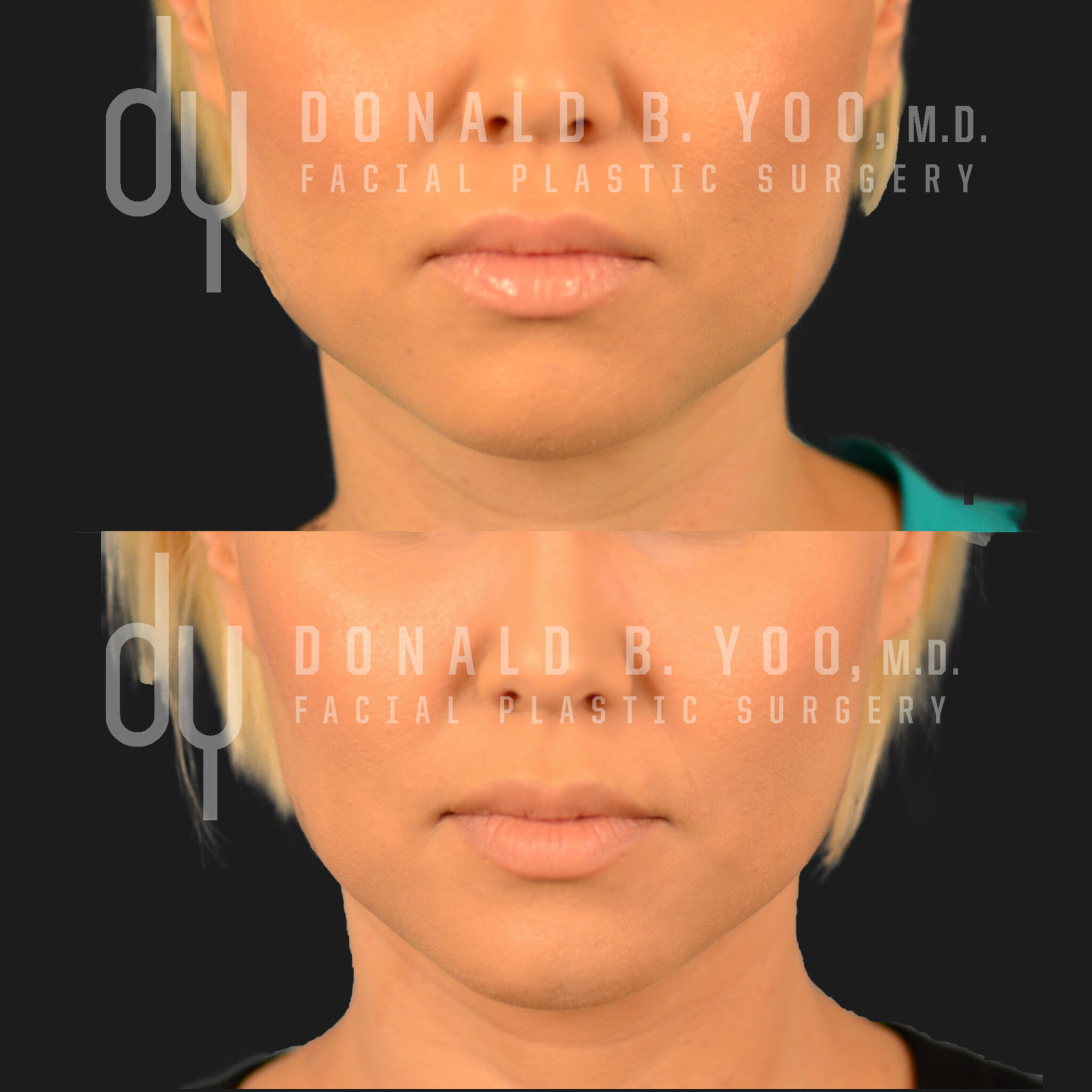 How many units of Botox does it take to reduce a masseter? | Beverly ...