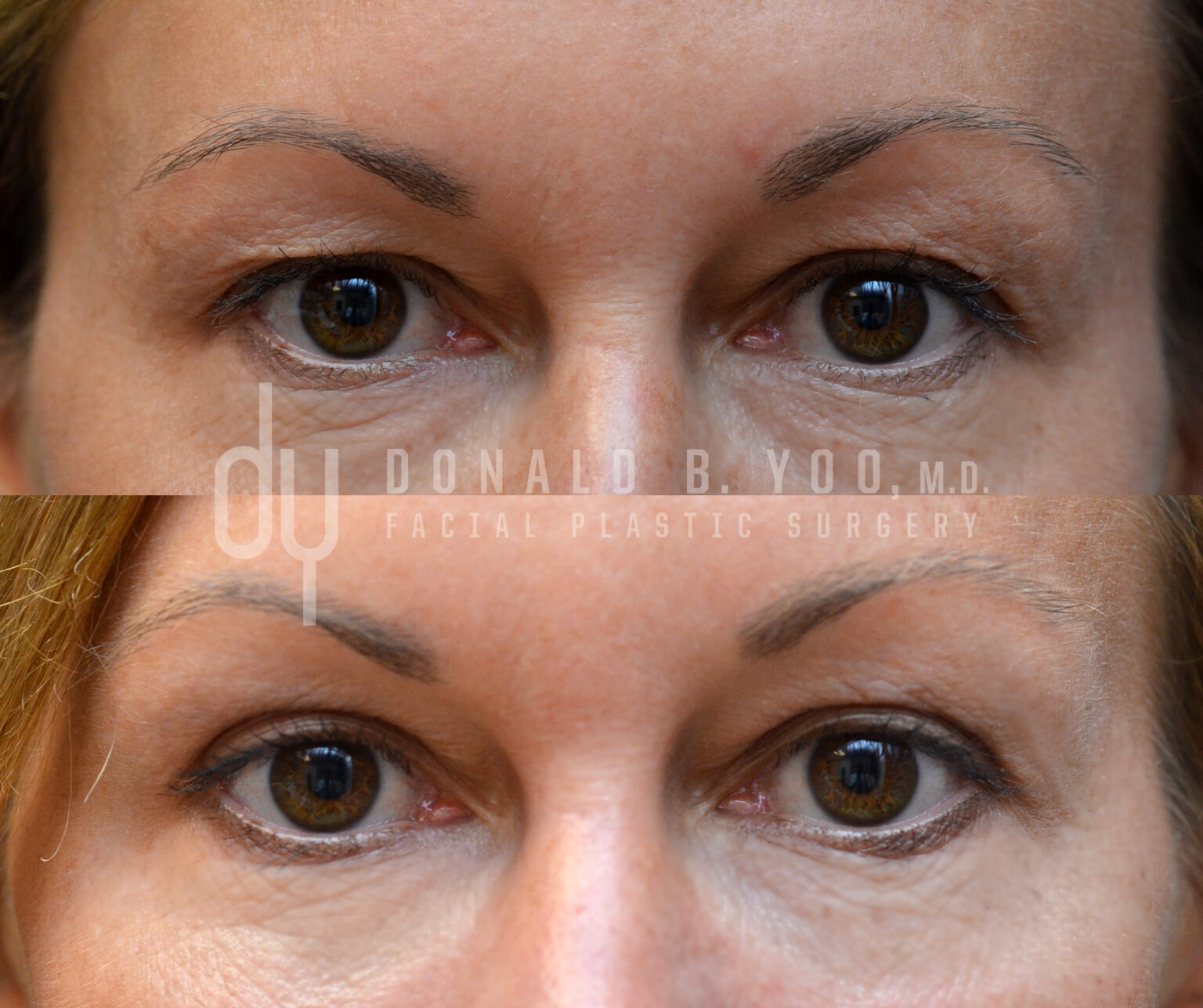 What is different about Asian blepharoplasty or Asian eyelid surgery ...