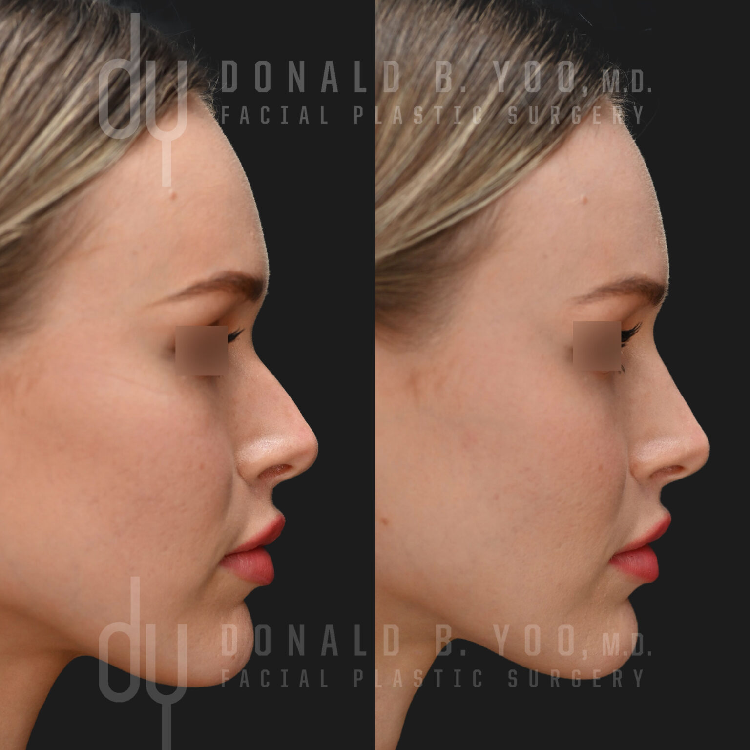 What is nose job without surgery? Is Rhinoplasty without surgery ...