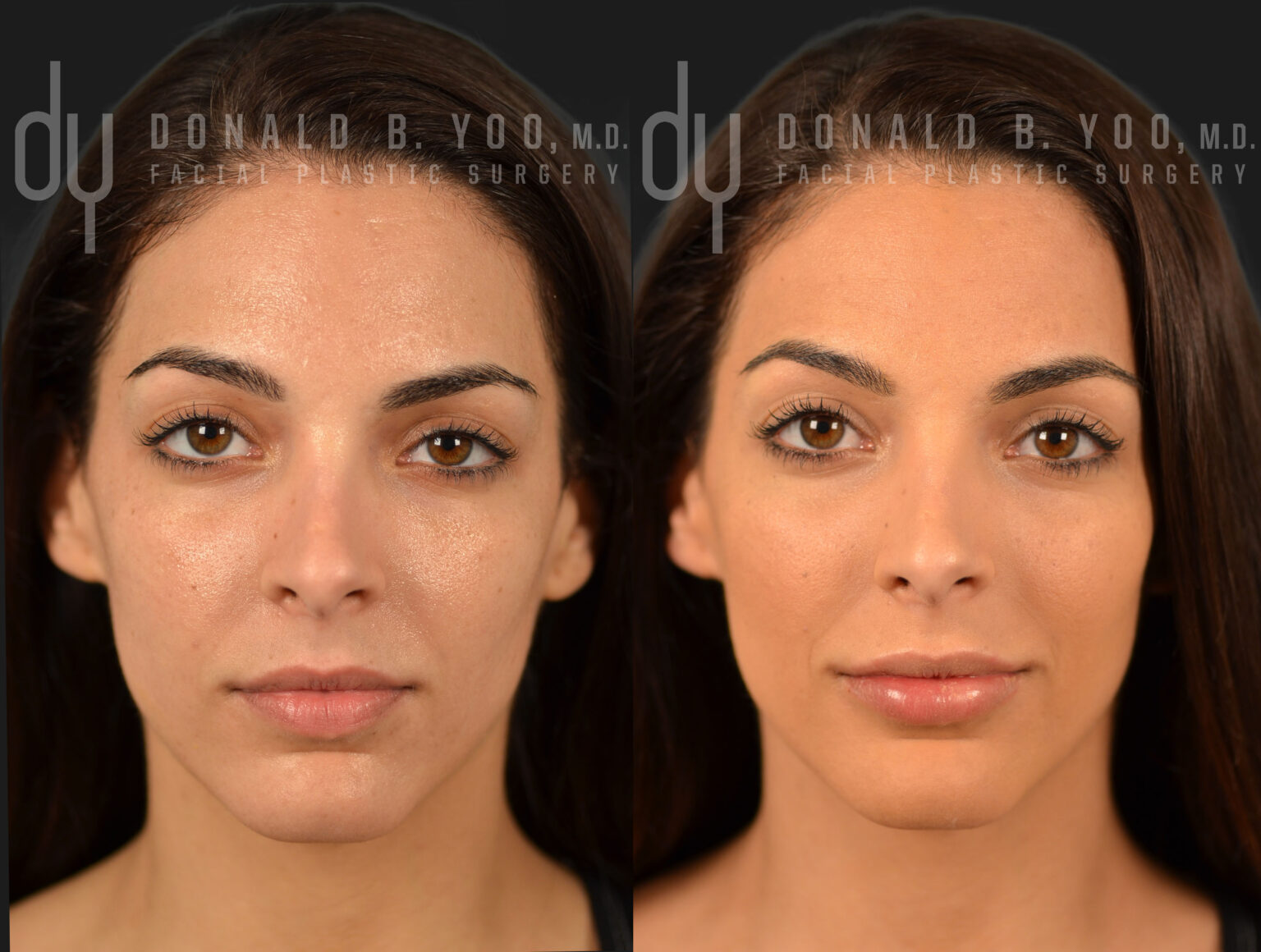 What is a lip augmentation? How long does lip augmentation last ...