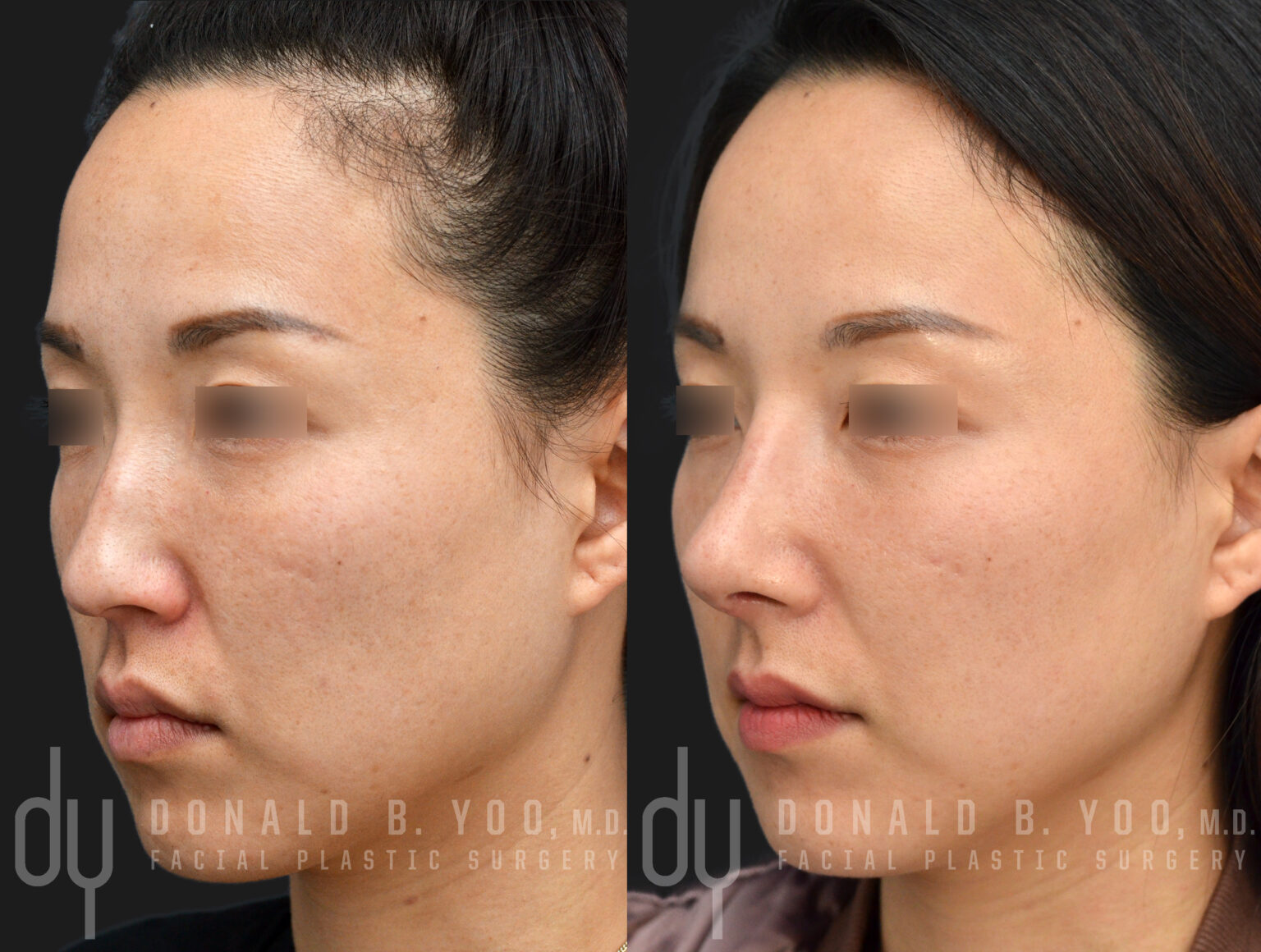 What's the best technique to augment the dorsum in Asian rhinoplasty or ...