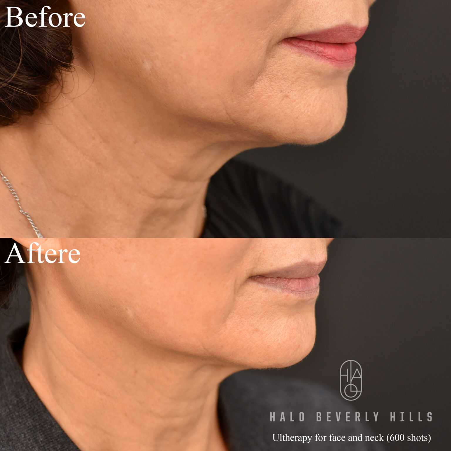 Ultherapy PRIME®: A Non-Invasive Approach to Skin Lifting and ...