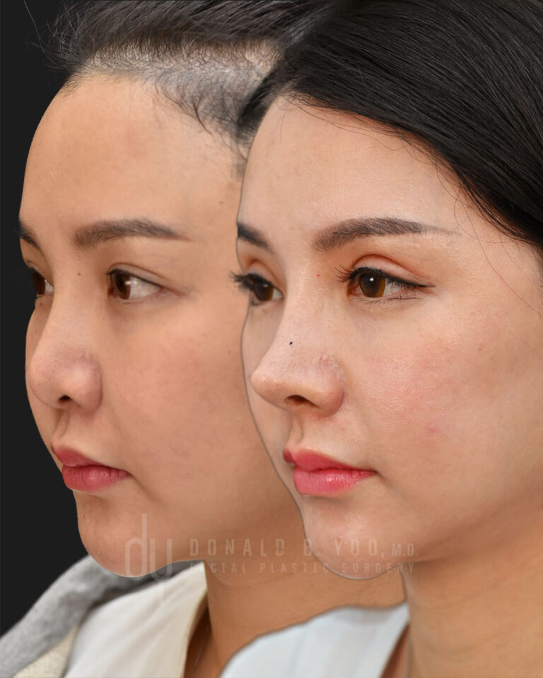 Beverly Hills Facial Plastic Surgery - Donald B. Yoo M.D. - Pretty to ...