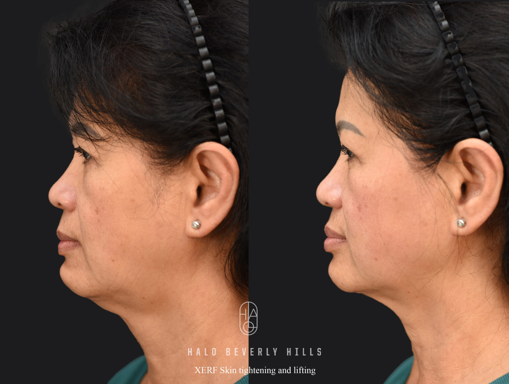 XERF Radiofrequency Skin Tightening: A Non-Surgical Option for Facial ...