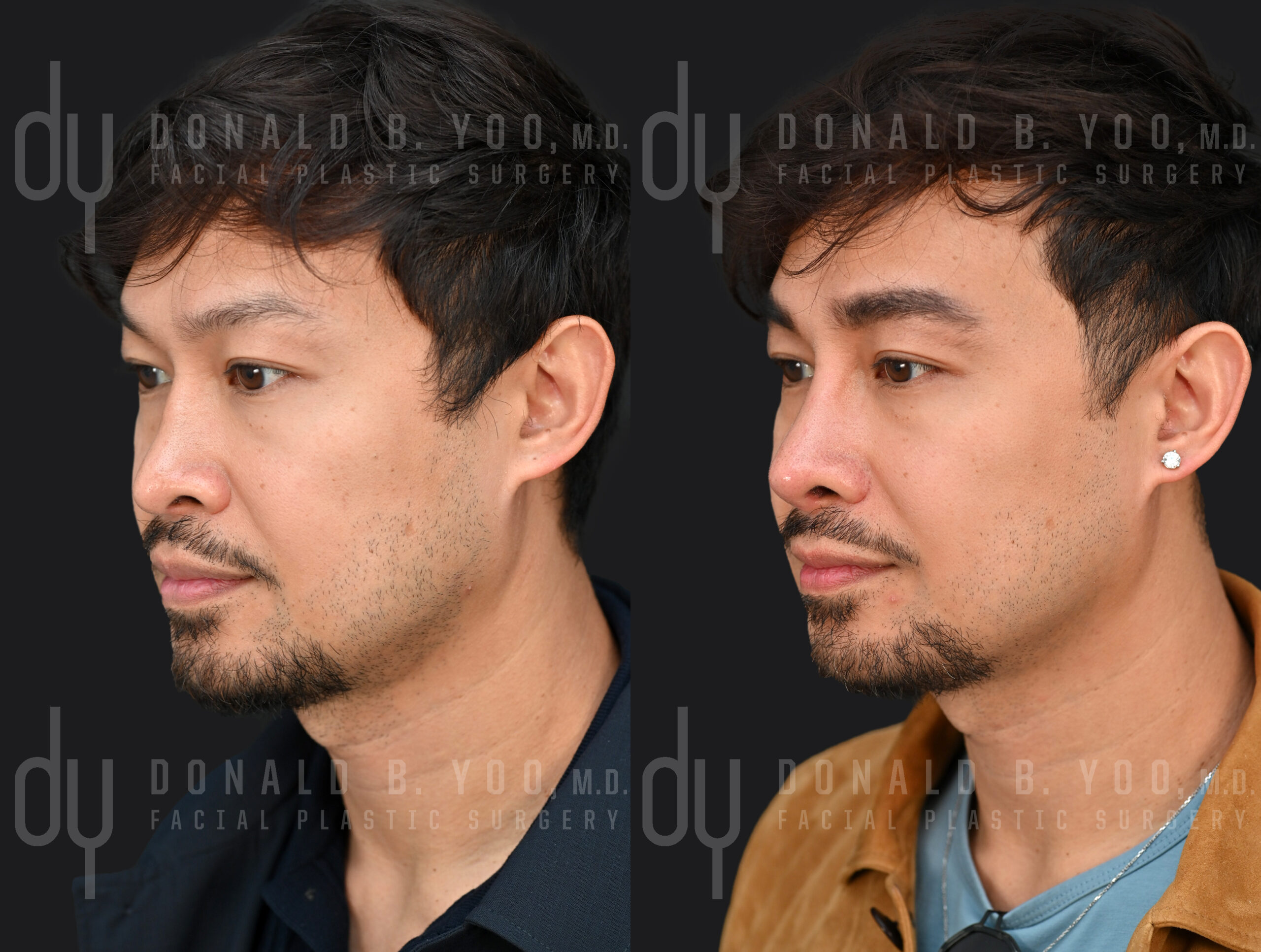 Are there differences between male and female Asian rhinoplasty ...