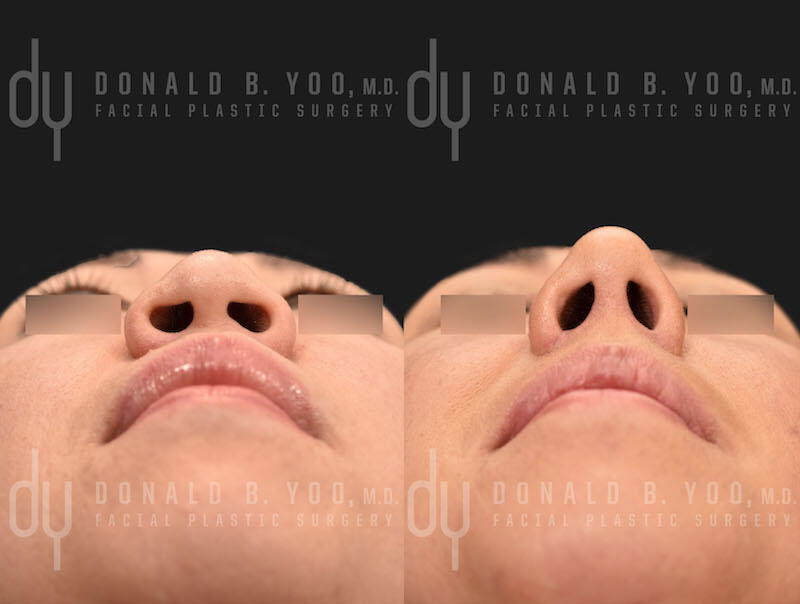 Alarplasty - Beverly Hills Facial Plastic Surgery - Donald B. Yoo M.D.