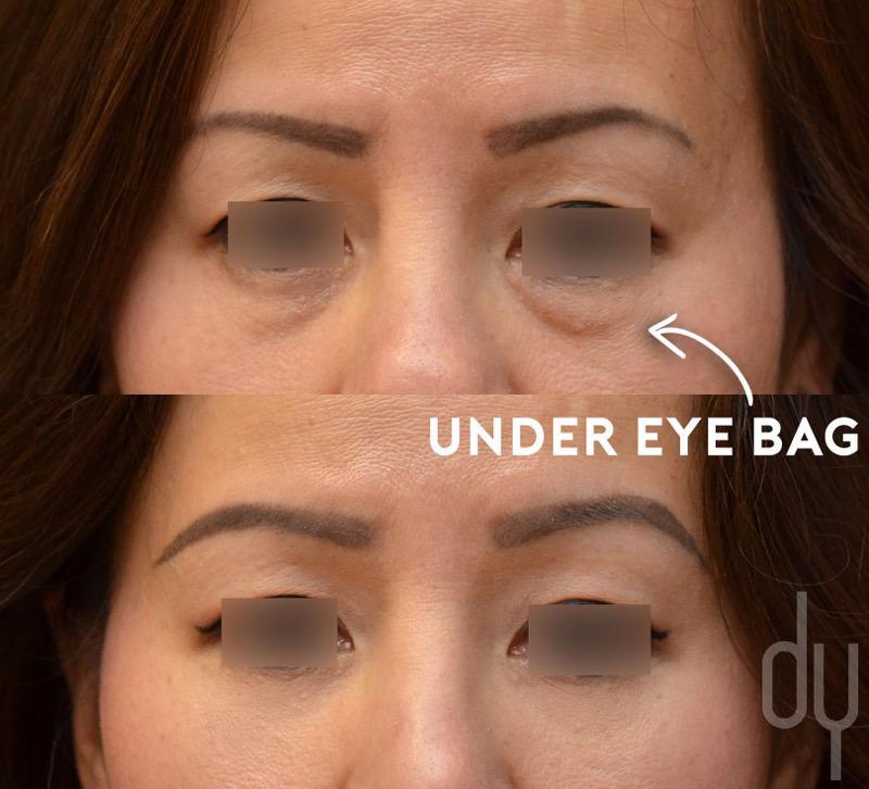 Lower Eyelid Blepharoplasty - Beverly Hills Facial Plastic Surgery ...